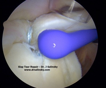 Shoulder Arthroscopy for Labral Tears: Advanced Care with Dr. Jared ...